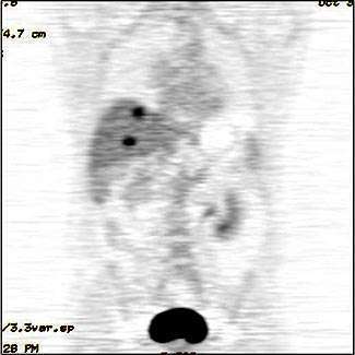 Positron Emission Tomography (PET) – Pancreatic Cancer Action Network