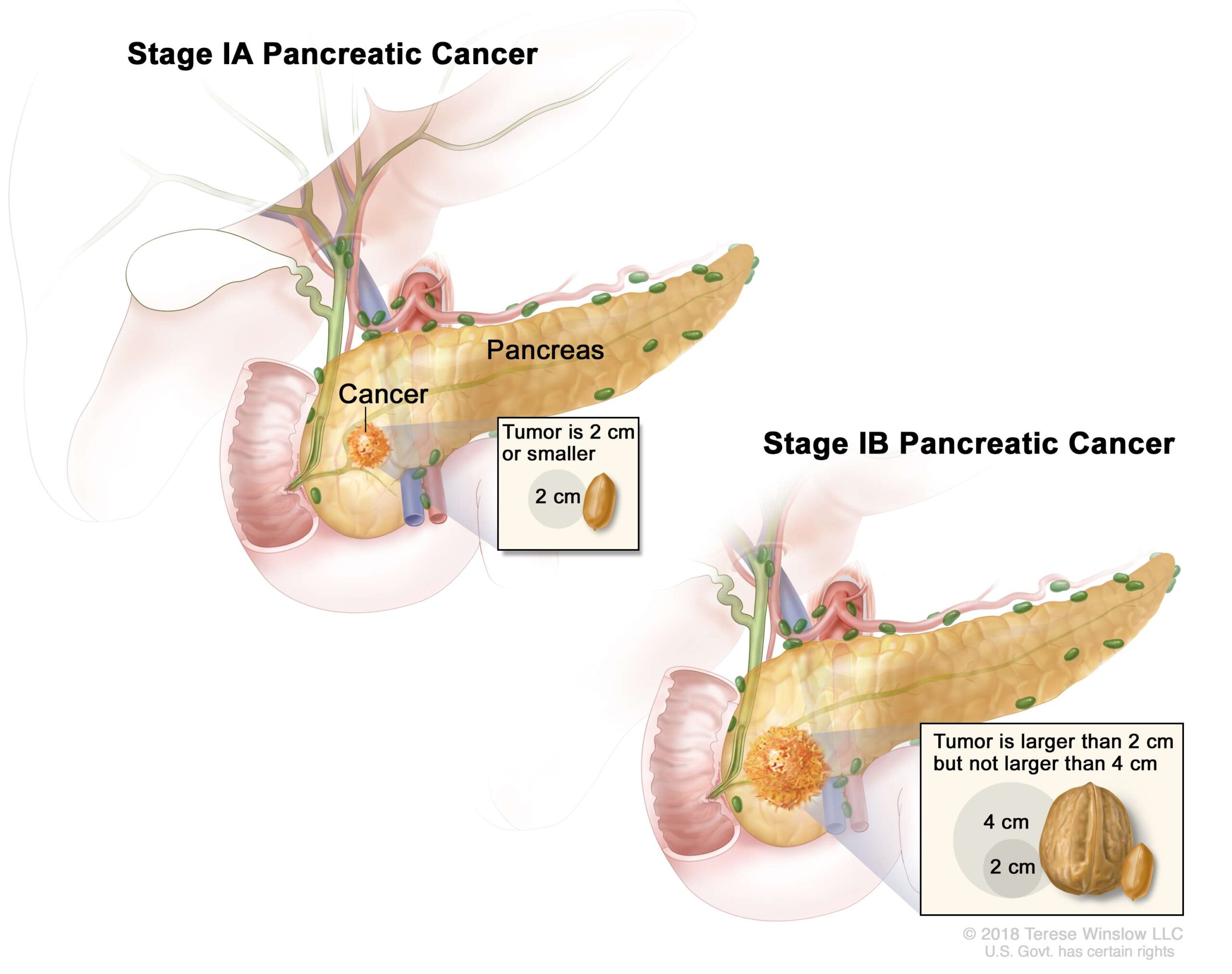 Whipple Procedure (Pancreaticoduodenectomy) - Pancreatic Cancer Action ...